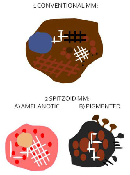 Clinical and Dermoscopic Morphology In Diagnosis of Melanoma in ...